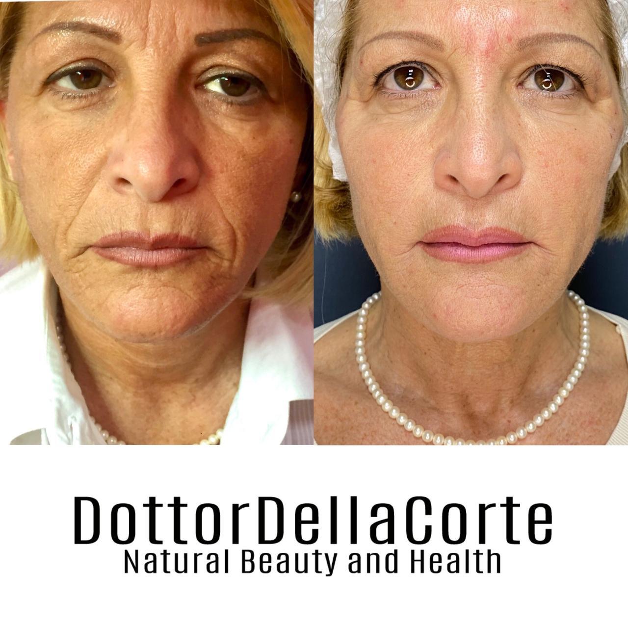 Liquid Lift - Napoli | Dottor Della Corte