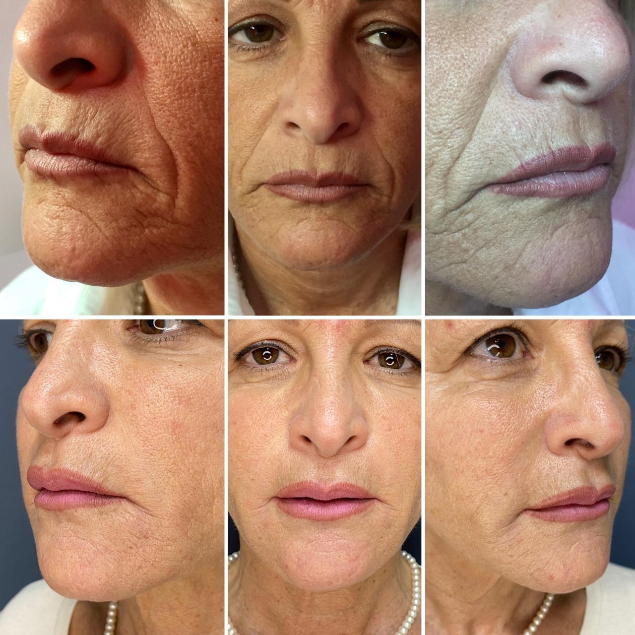 Liquid Lift - Napoli | Dottor Della Corte