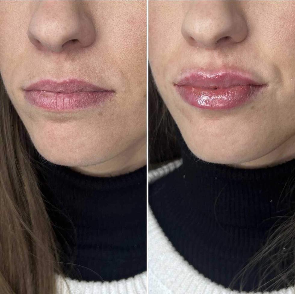 Filler labbra - Napoli | Dottor Della Corte