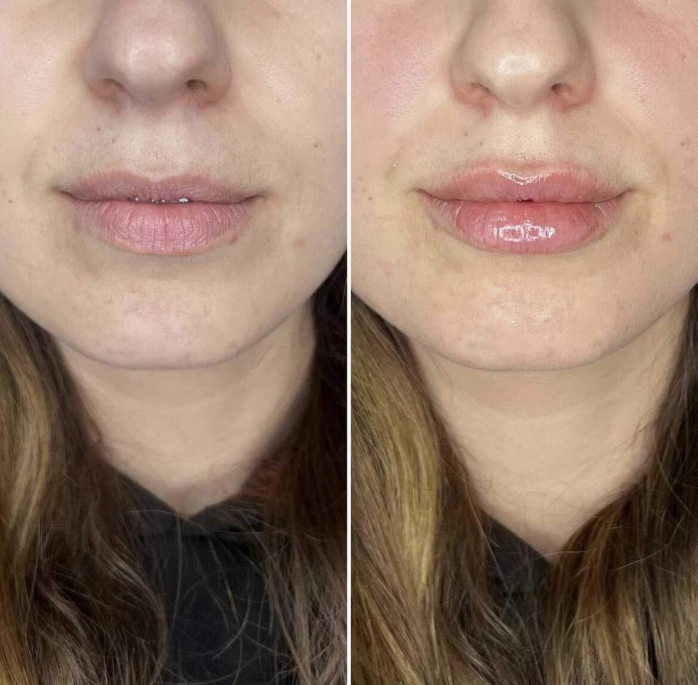 Filler labbra - Napoli | Dottor Della Corte